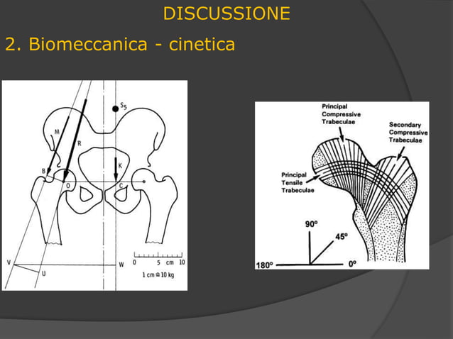 Osteonecrosi testa femorale caso clinico | PPT