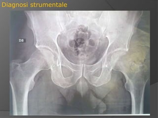 Osteonecrosi testa femorale caso clinico | PPT
