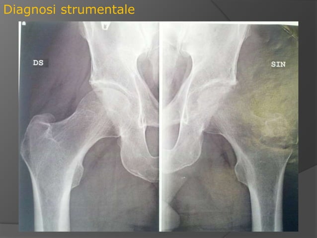 Osteonecrosi testa femorale caso clinico | PPT