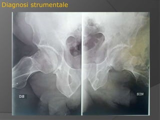 Osteonecrosi testa femorale caso clinico | PPT