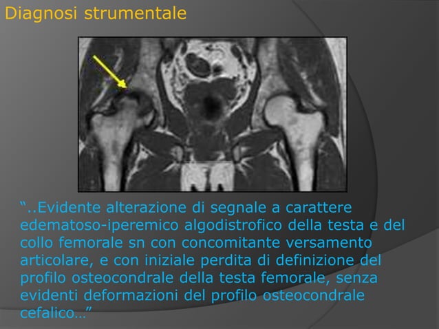 Osteonecrosi testa femorale caso clinico | PPT