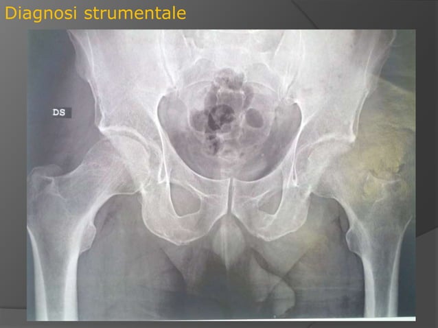 Osteonecrosi testa femorale caso clinico | PPT