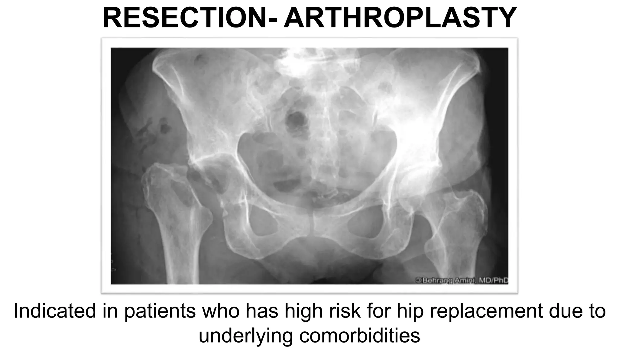 rheumatoid arthritis & surgical management | PPTX