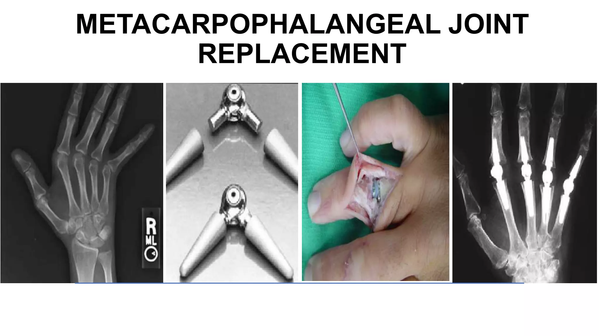 rheumatoid arthritis & surgical management | PPTX