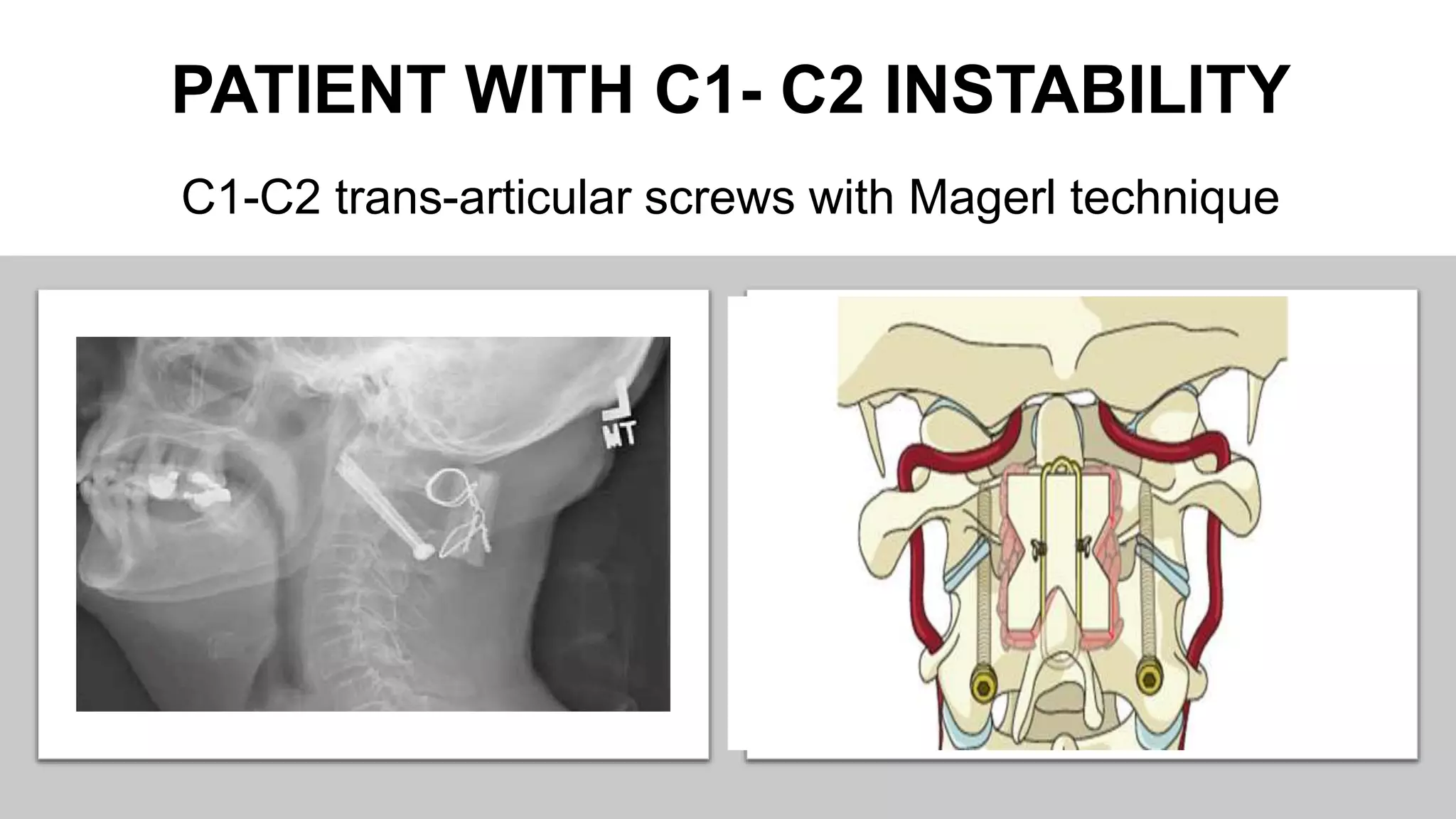 rheumatoid arthritis & surgical management | PPTX