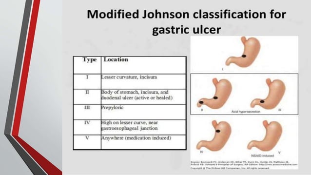 Perforated Gastric ULCER | PPT