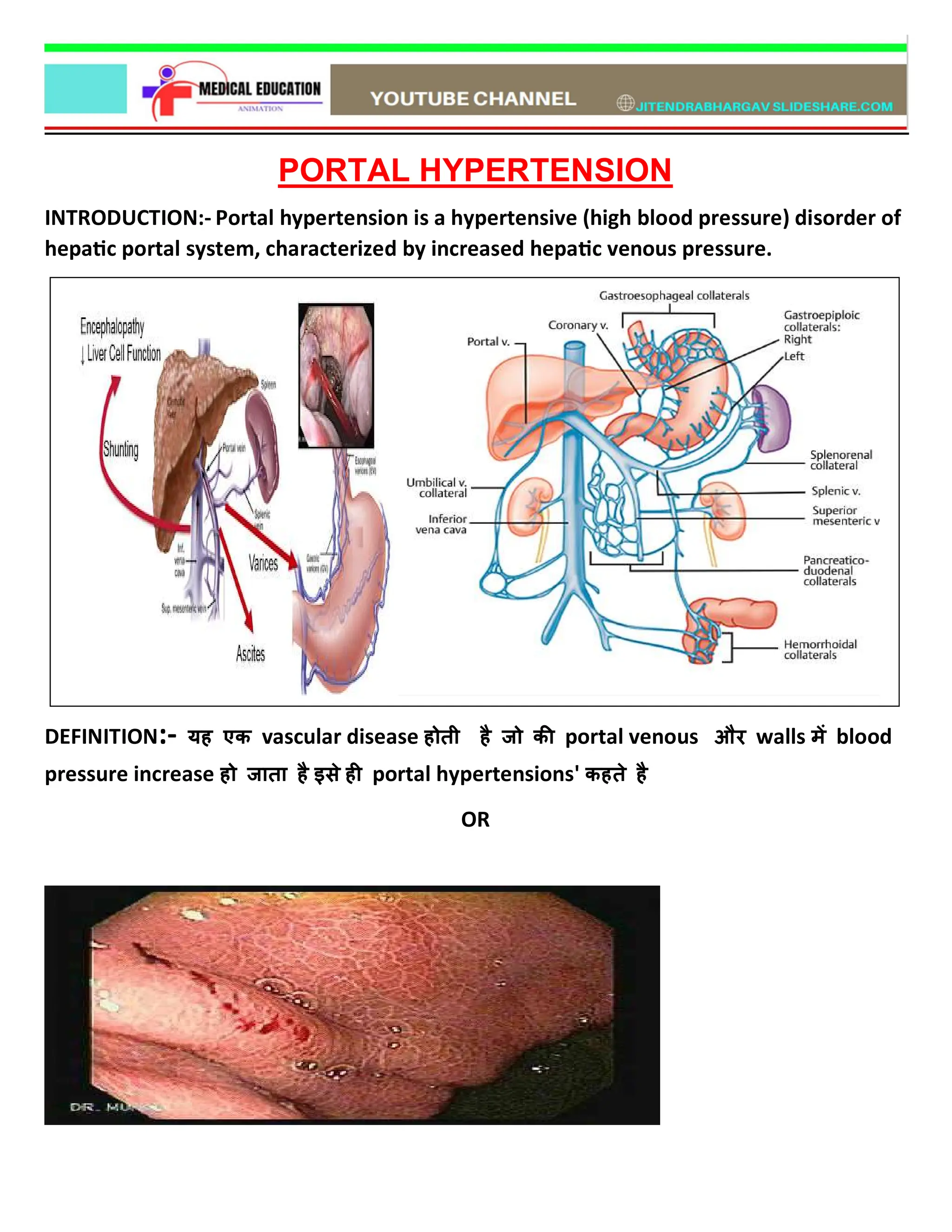 Portal hypertension medical surgical nursing Jitendra bhargav ...