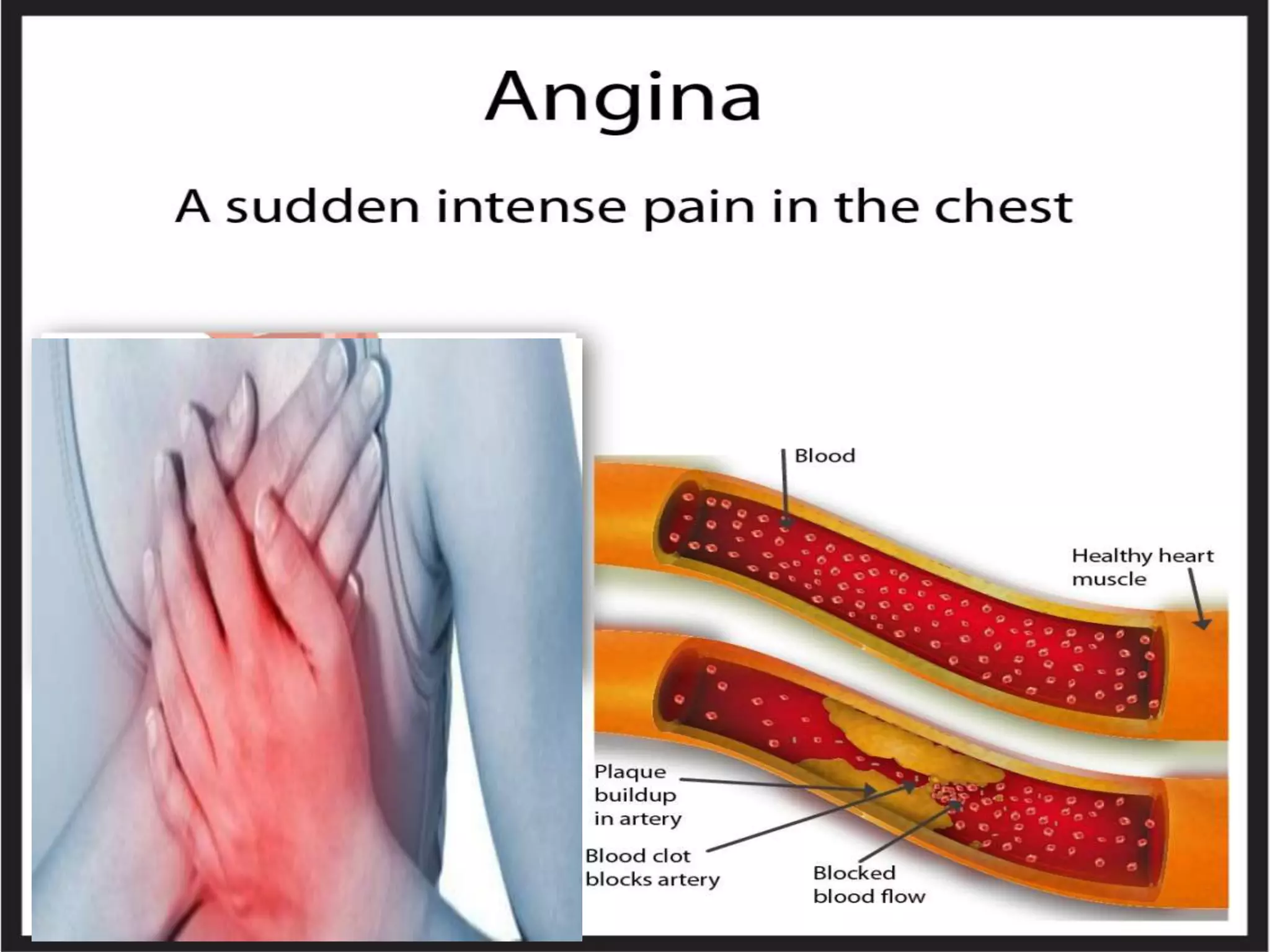 PH1.28 Angina pectoris MANI.ppt