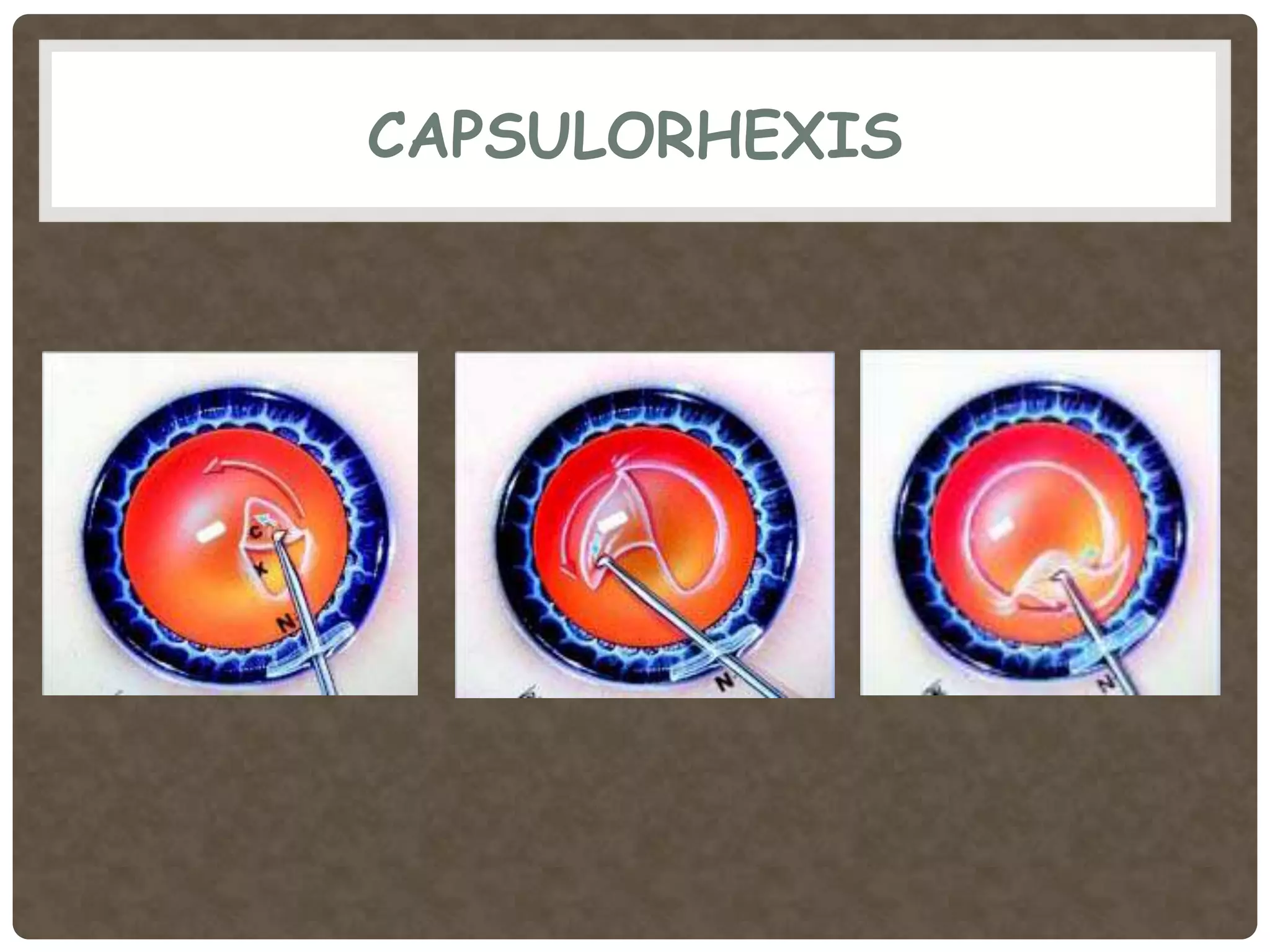 Phacoemulsification | PPTX