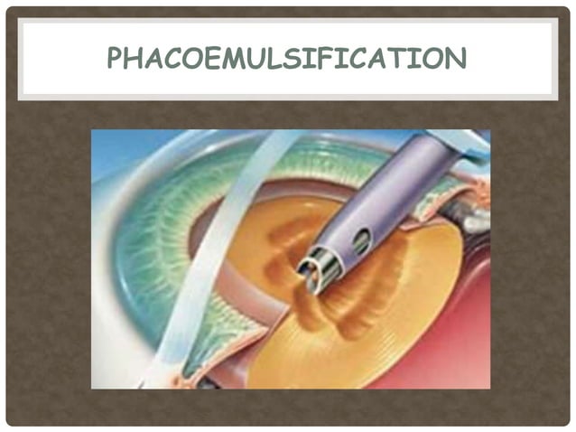 Phacoemulsification | PPTX