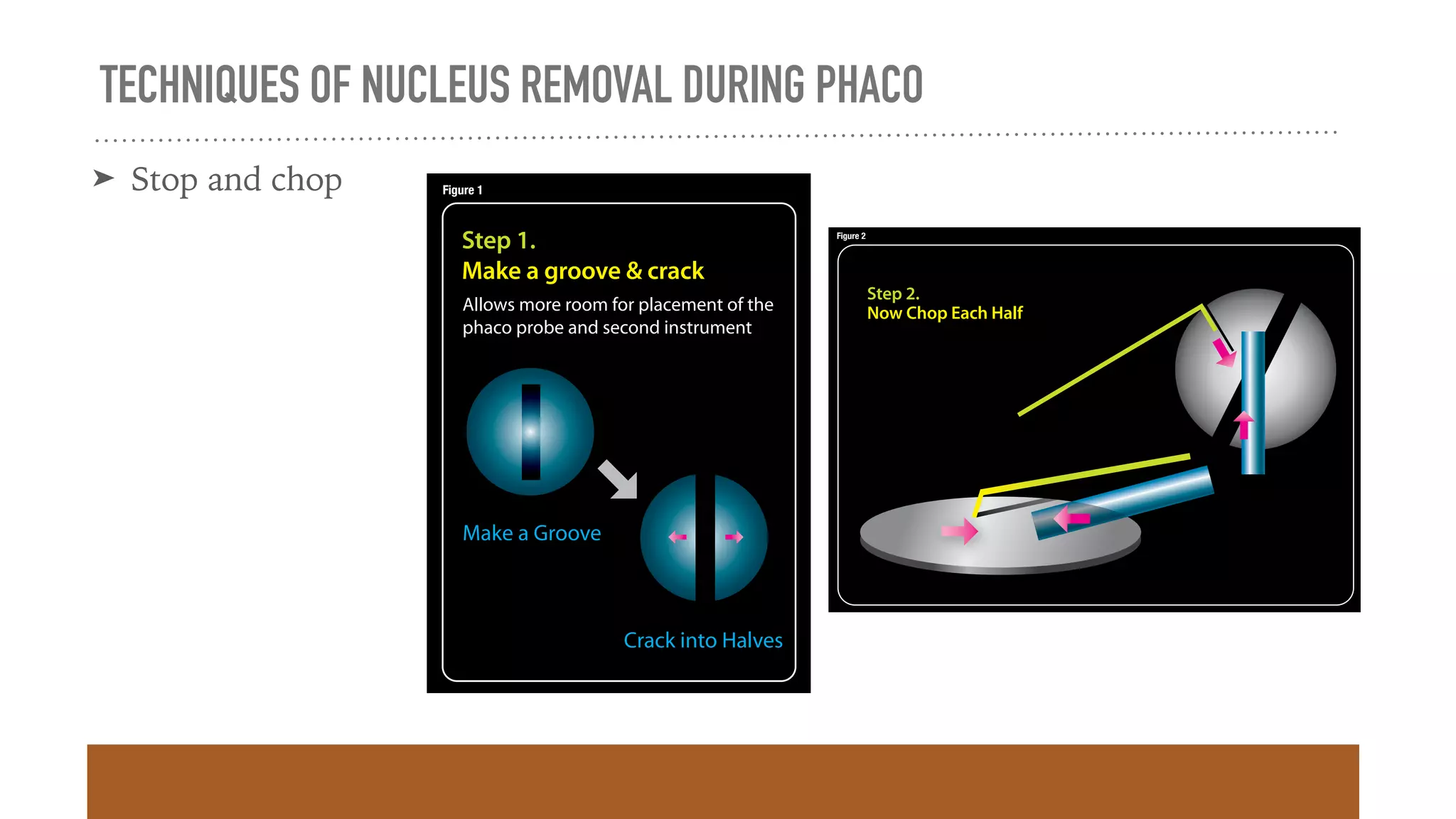 Phacoemulsification: Phacodynamics | PDF