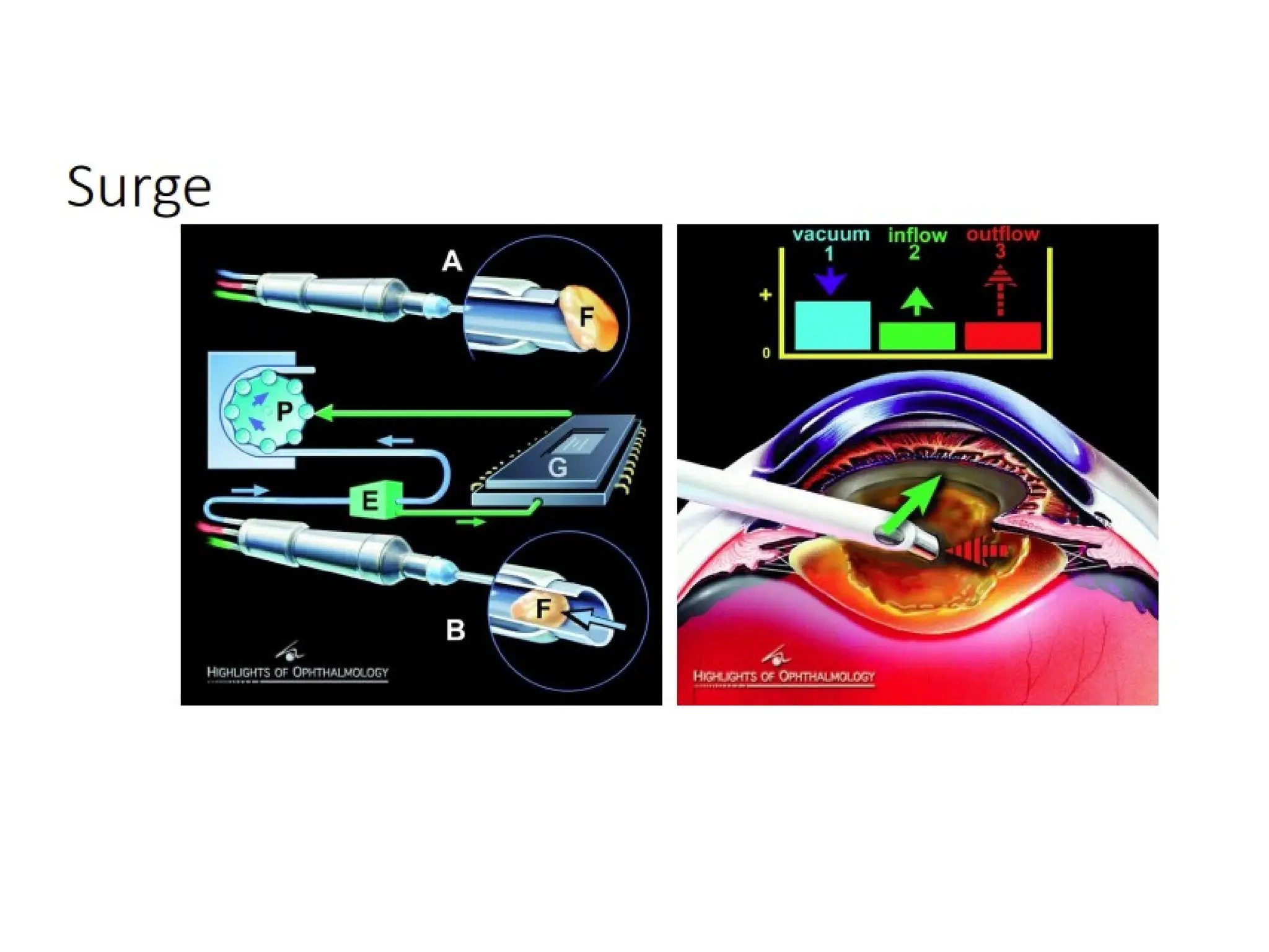 Phacodynamics of phacoemulsification of cataract.pptx