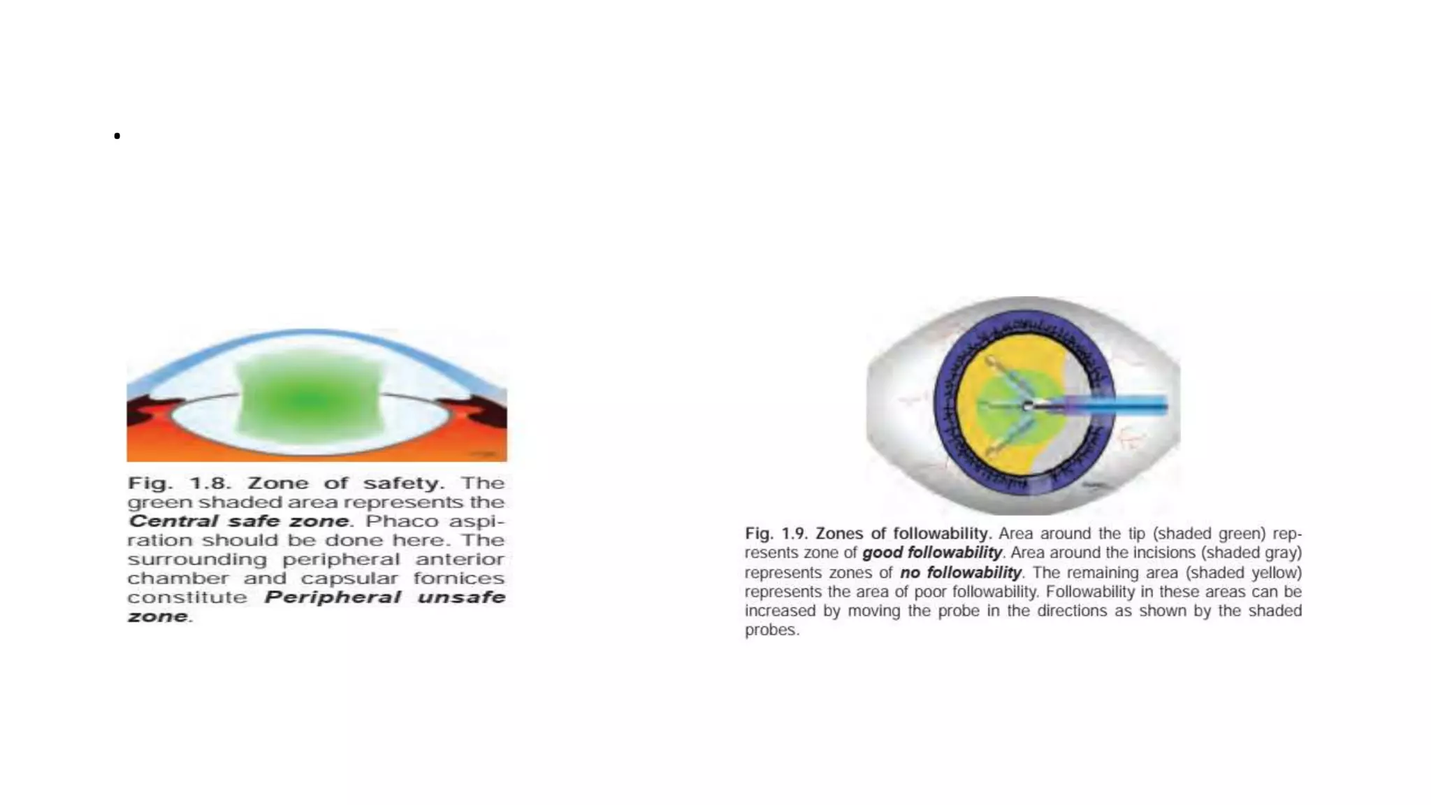 Phacodynamics by dr iddi | PPT