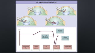 Phacodynamics in Phaco.pptx
