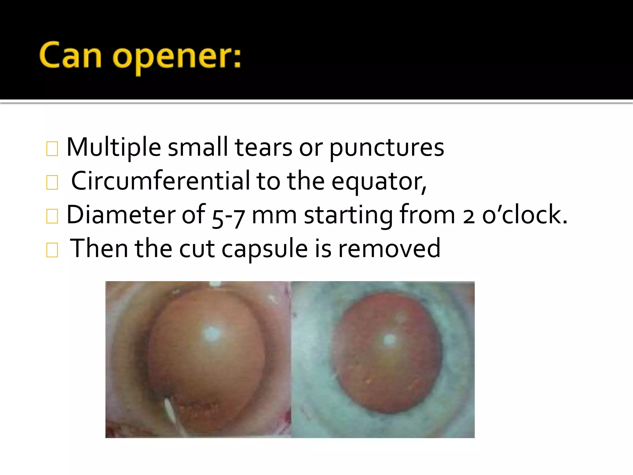 Phacoemulsification | PPTX