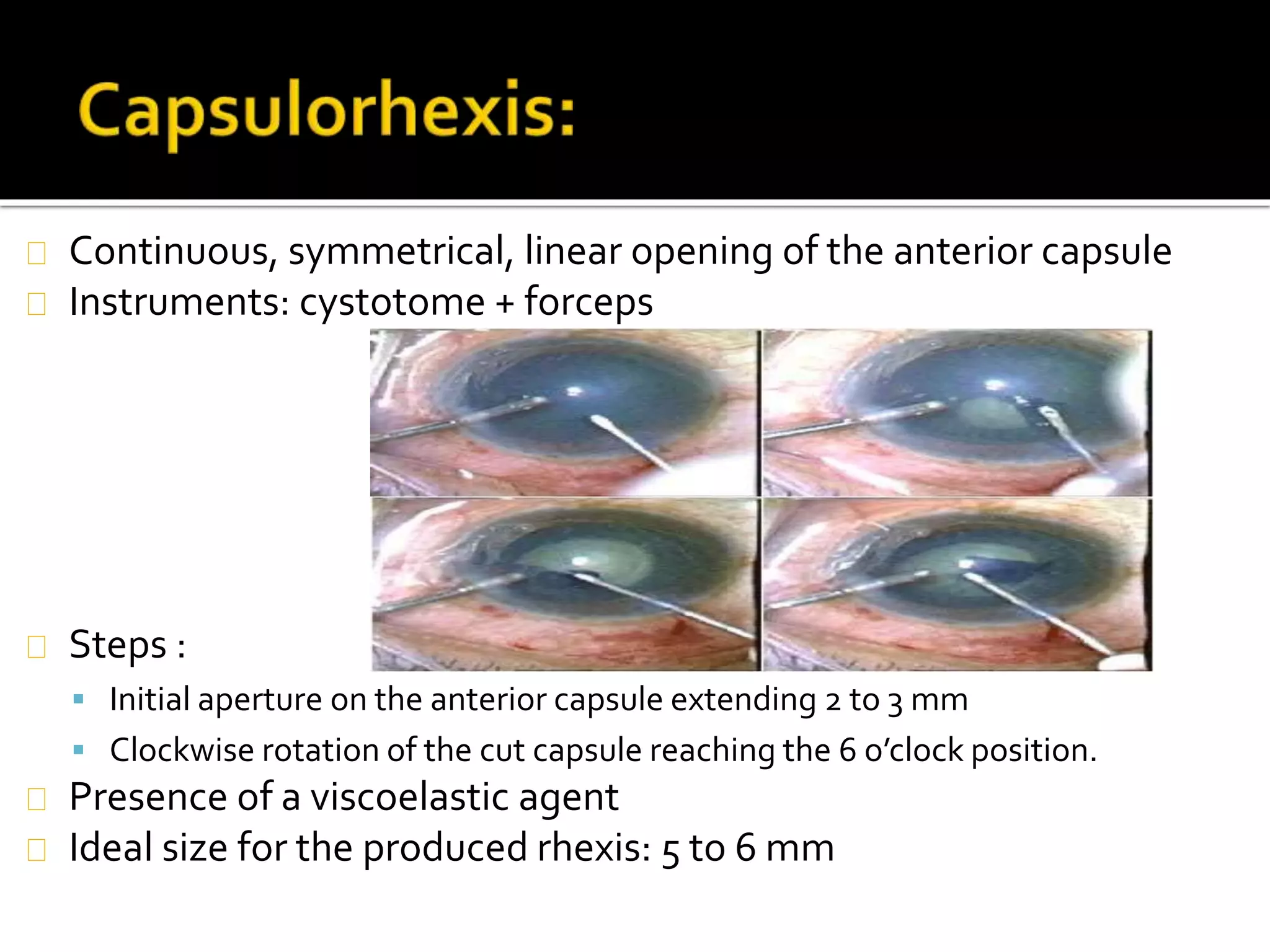 Phacoemulsification | PPTX