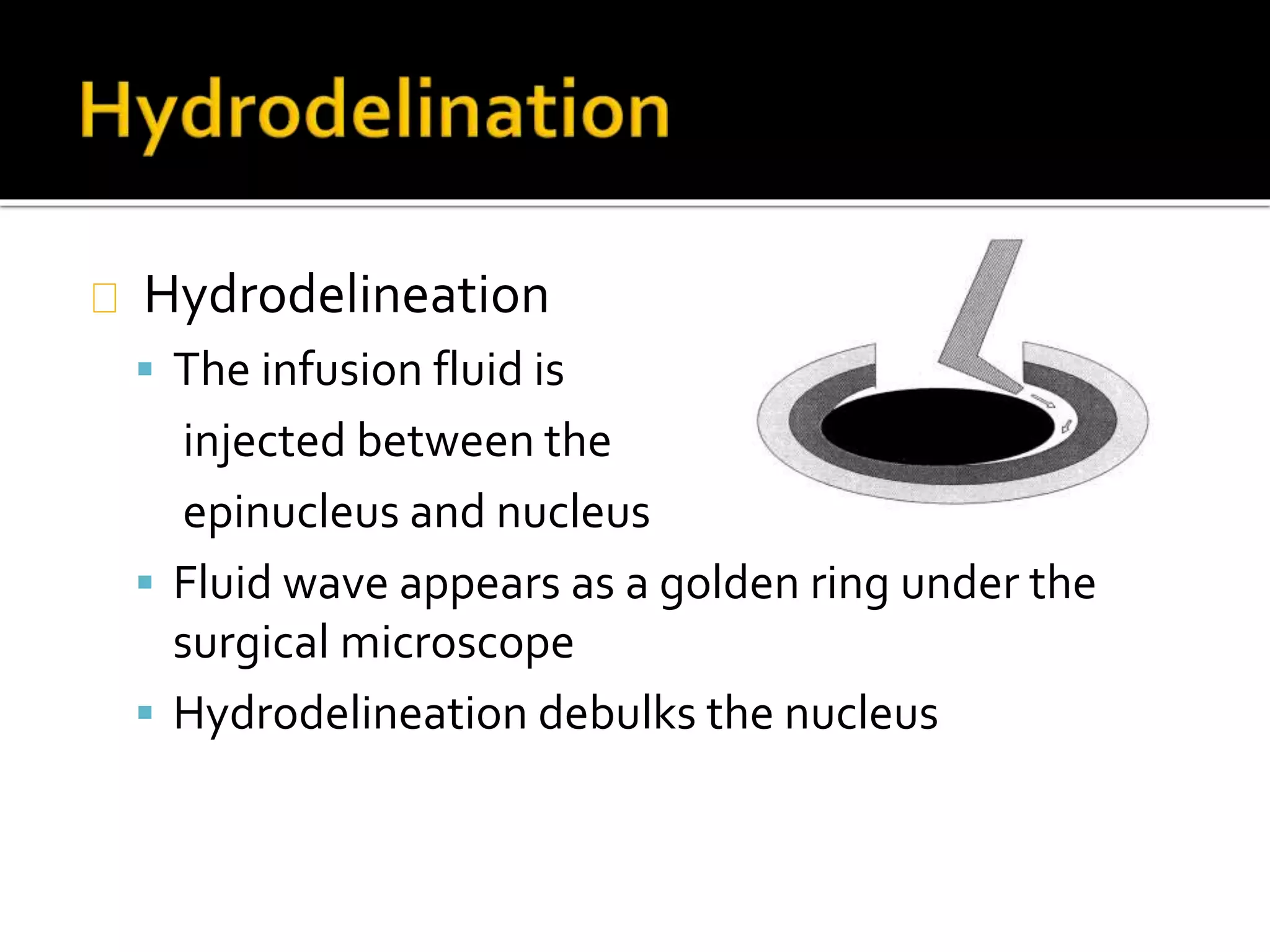 Phacoemulsification | PPTX