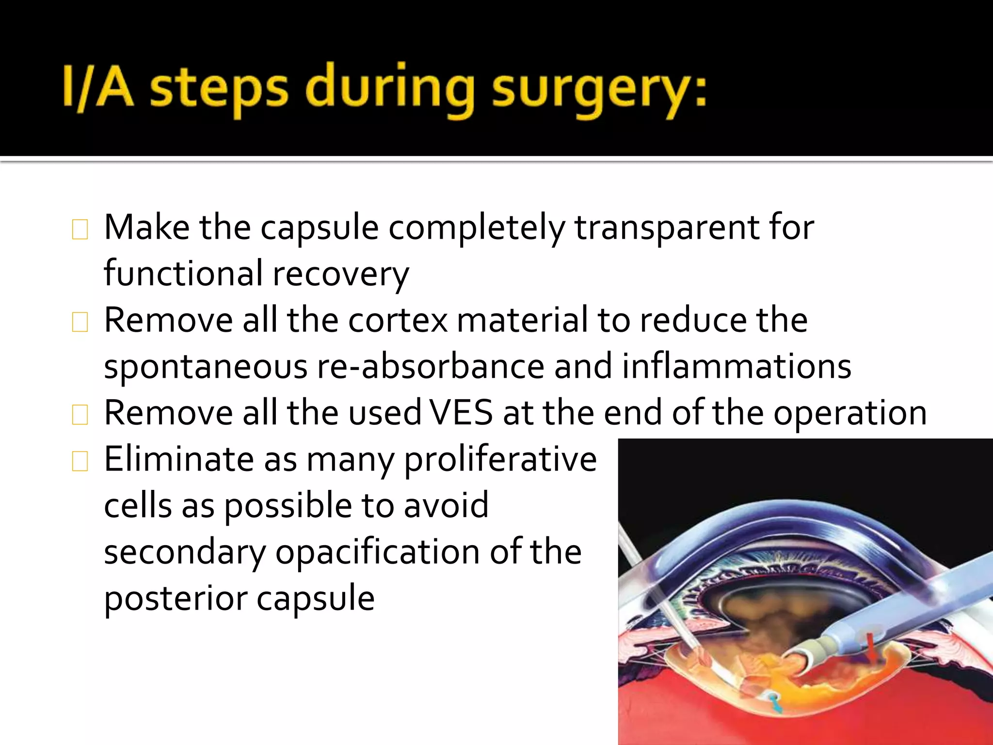 Phacoemulsification | PPTX