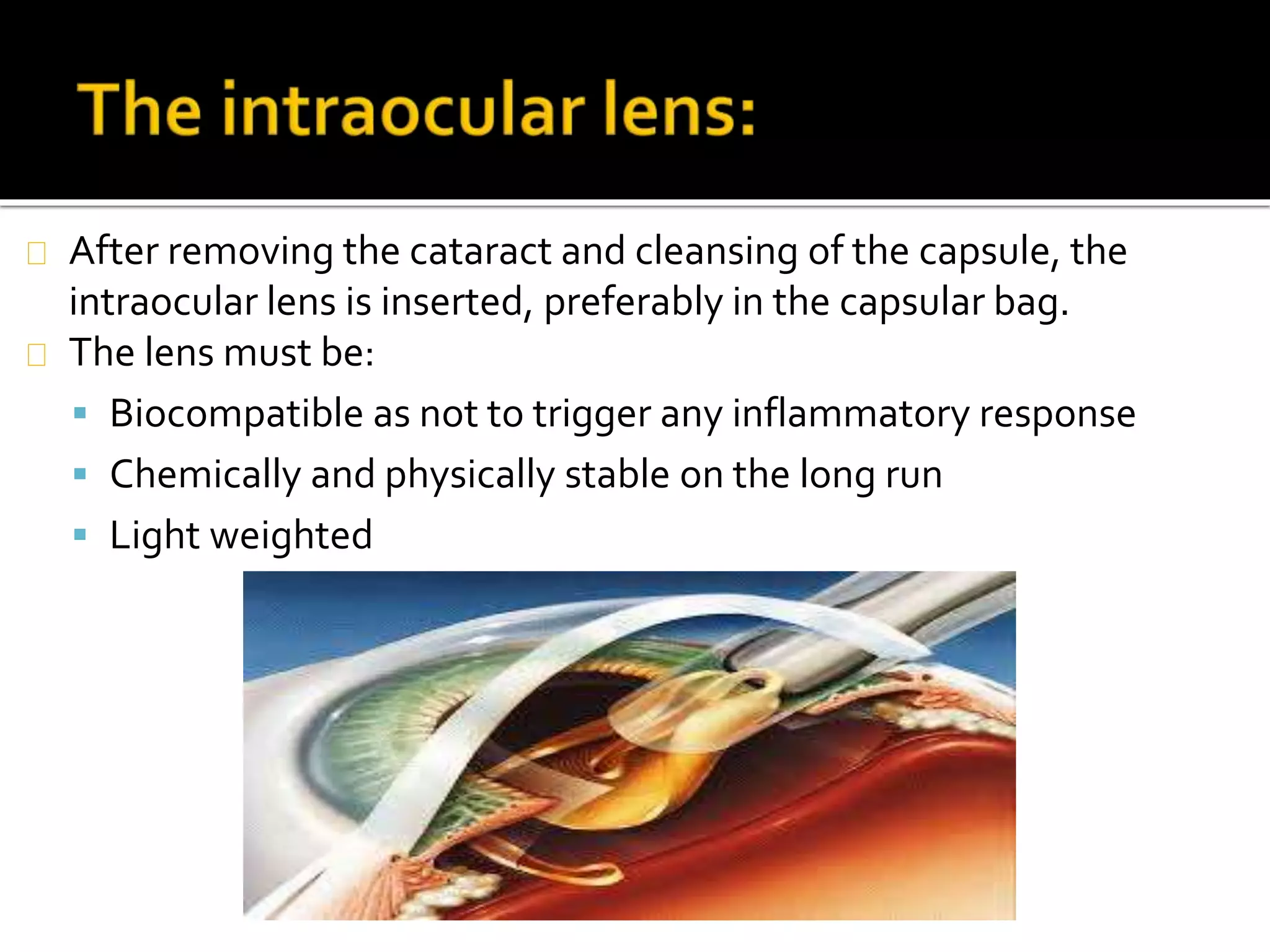 Phacoemulsification | PPTX