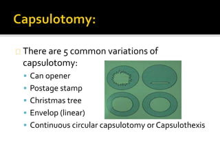 Phacoemulsification | PPTX