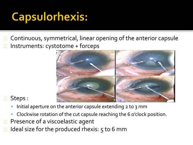 Phacoemulsification | PPTX | Eye and Vision Conditions | Diseases and Conditions