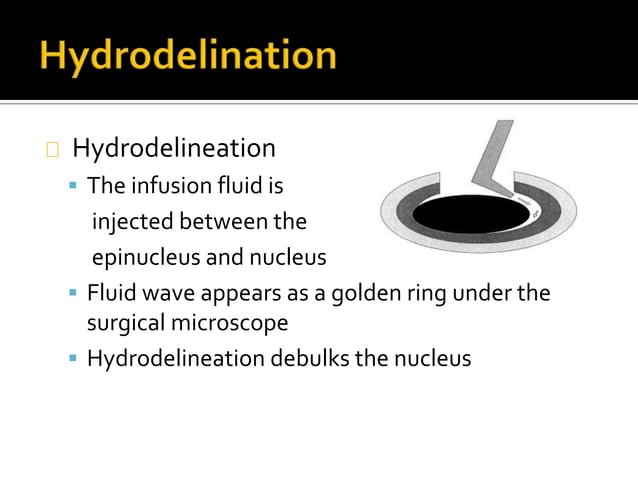 Phacoemulsification | PPTX | Eye and Vision Conditions | Diseases and Conditions