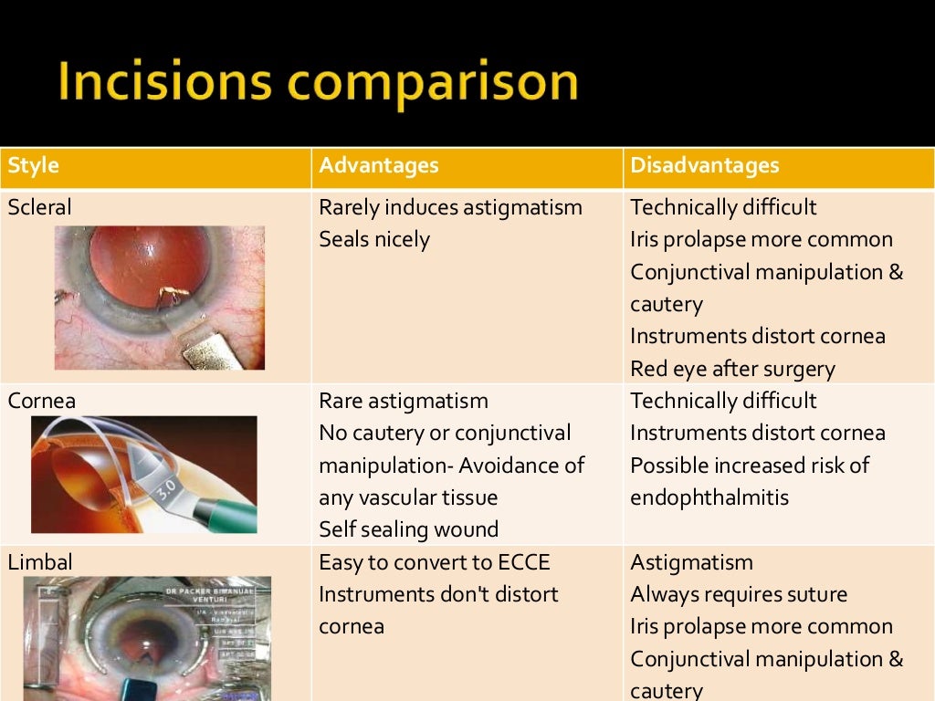 Phacoemulsification