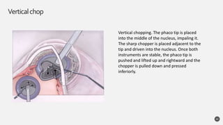 Phacoemulsification | PPTX