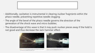 Phacoemulsification part 1 | PPTX