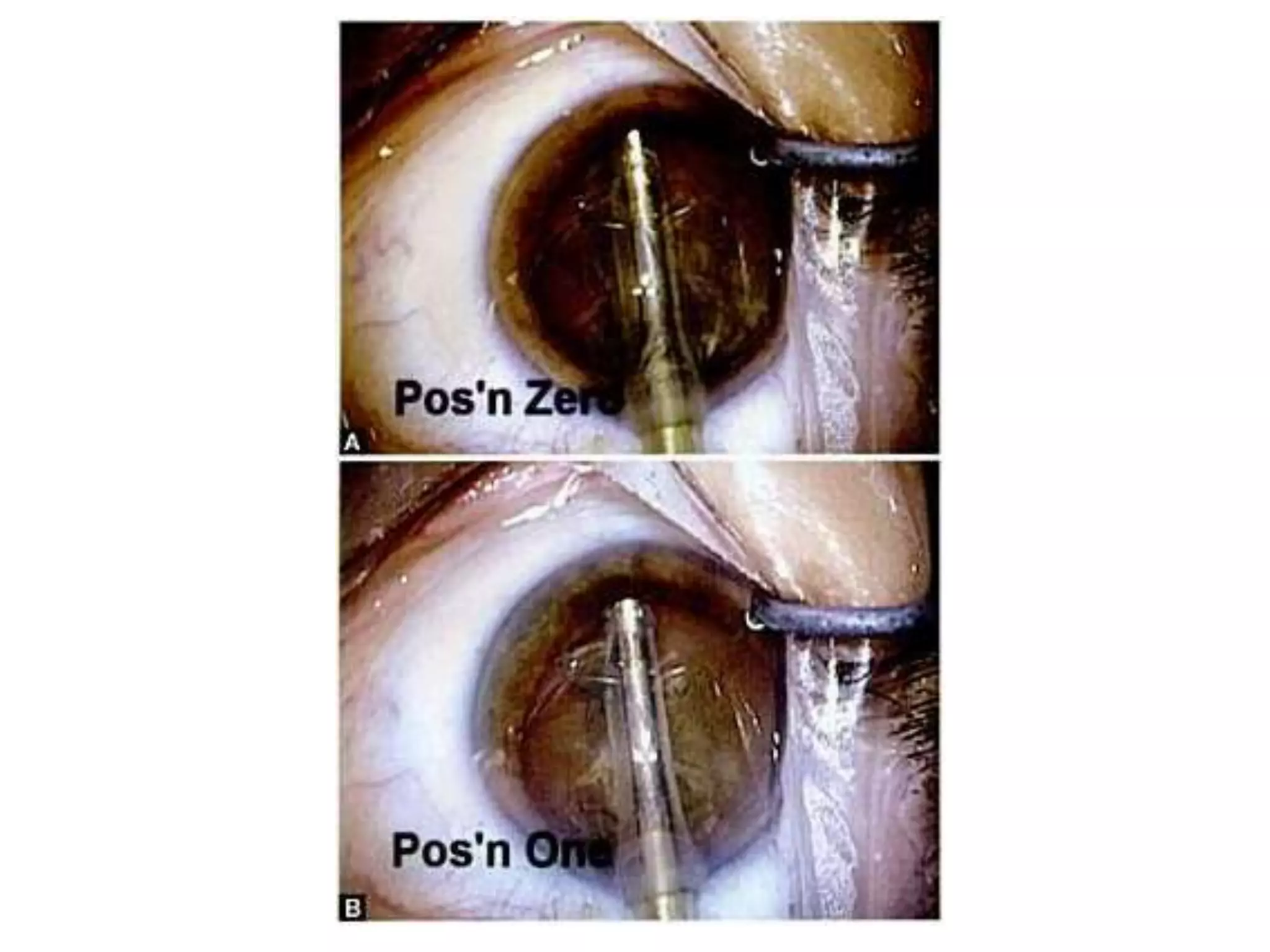 Phacoemulsification in myopic eyes | PPTX