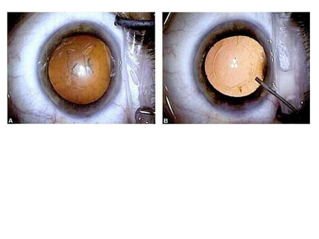 Phacoemulsification in myopic eyes | PPTX | Eye and Vision Conditions ...