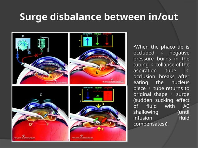 phacodynamics basics what you need to know | PPTX