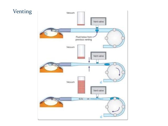 Phacomachine and its dynamics