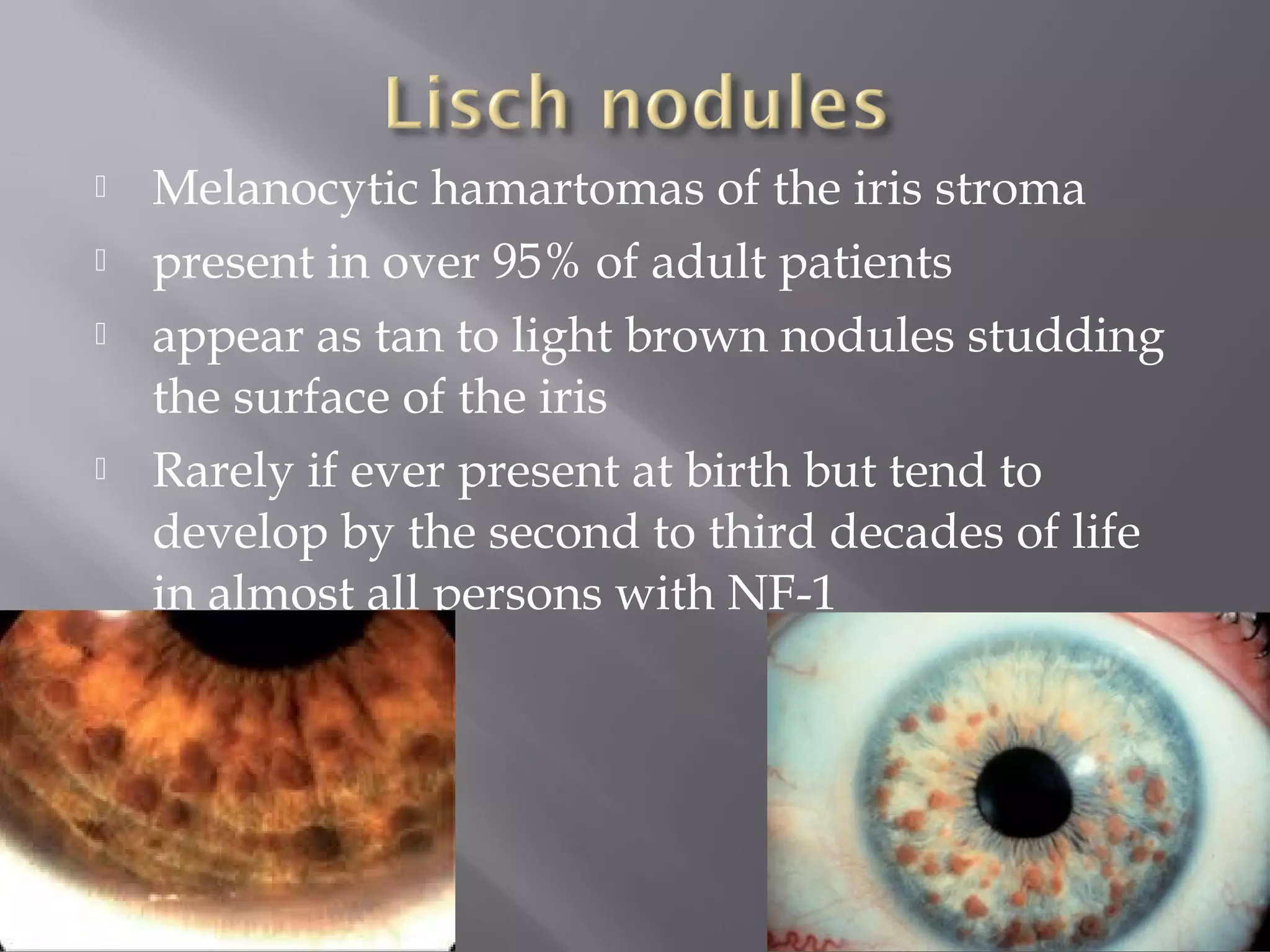 Phacomatosis | PPT