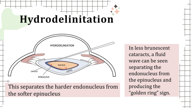 PHACO STEP.pptx | Eye and Vision Conditions | Diseases and Conditions