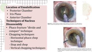 PHACO STEP.pptx
