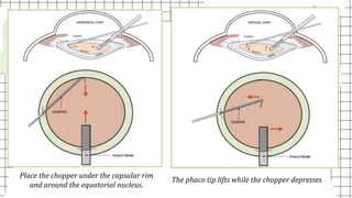 PHACO STEP.pptx