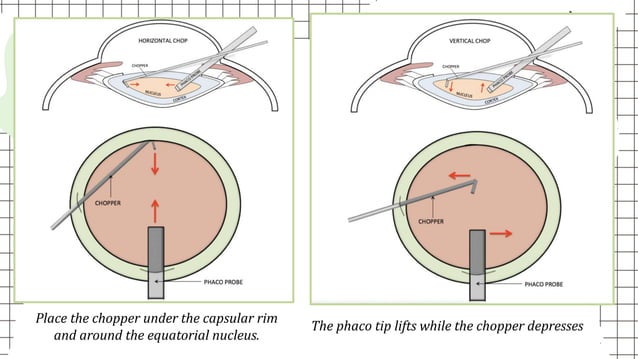 PHACO STEP.pptx | Eye and Vision Conditions | Diseases and Conditions