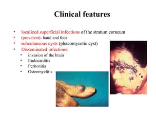 T tvsvsBxgsvsvbsgsPhaeohyphomycosis.2025.pptx