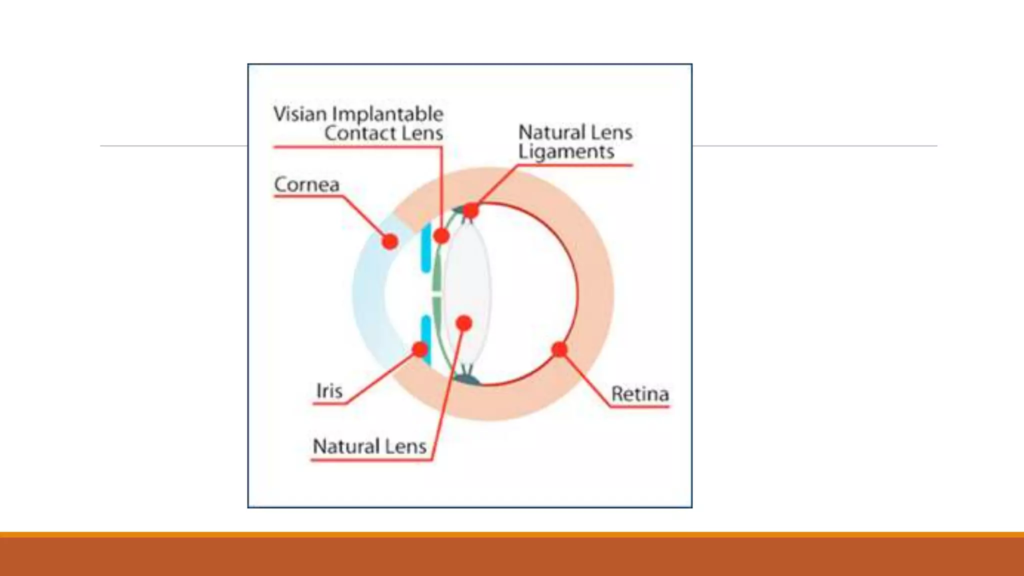Phakic intraocular lens | PPTX