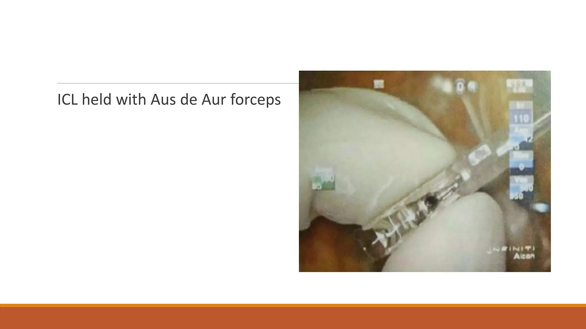 Phakic intraocular lens | PPTX