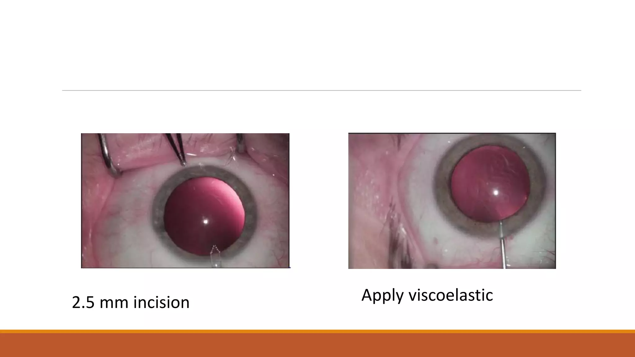 Phakic intraocular lens | PPTX