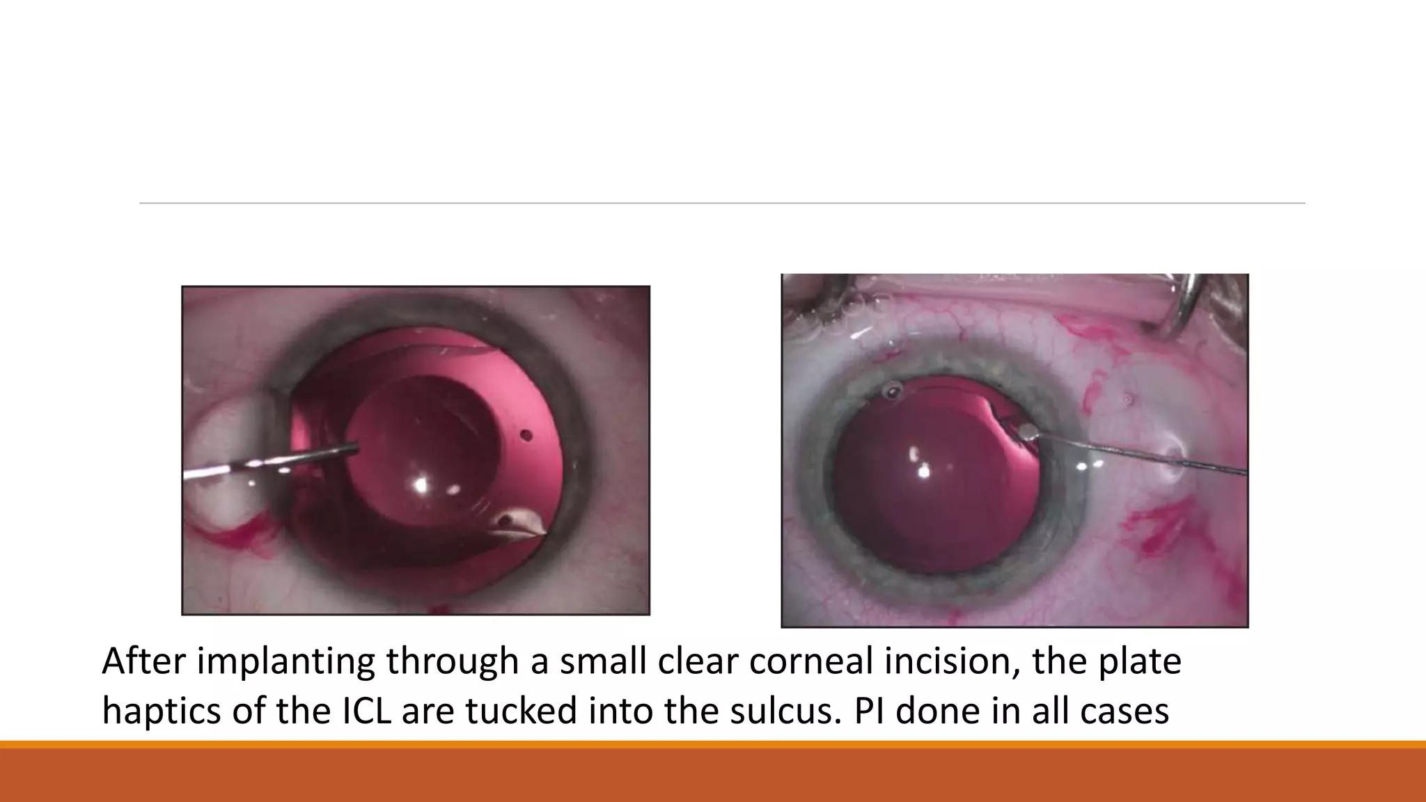 Phakic intraocular lens | PPTX