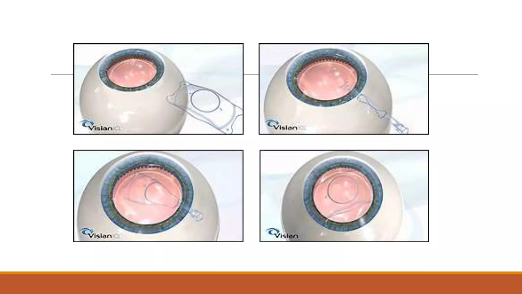 Phakic intraocular lens | PPTX