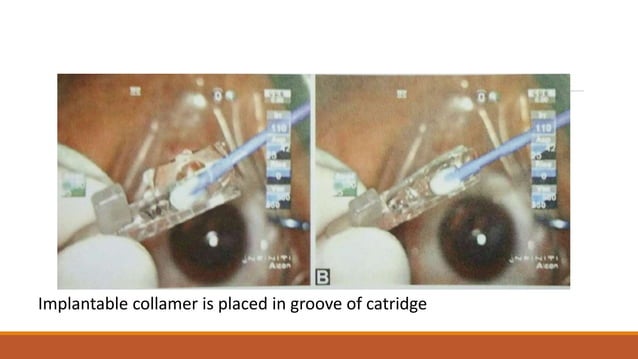 Phakic intraocular lens | PPTX