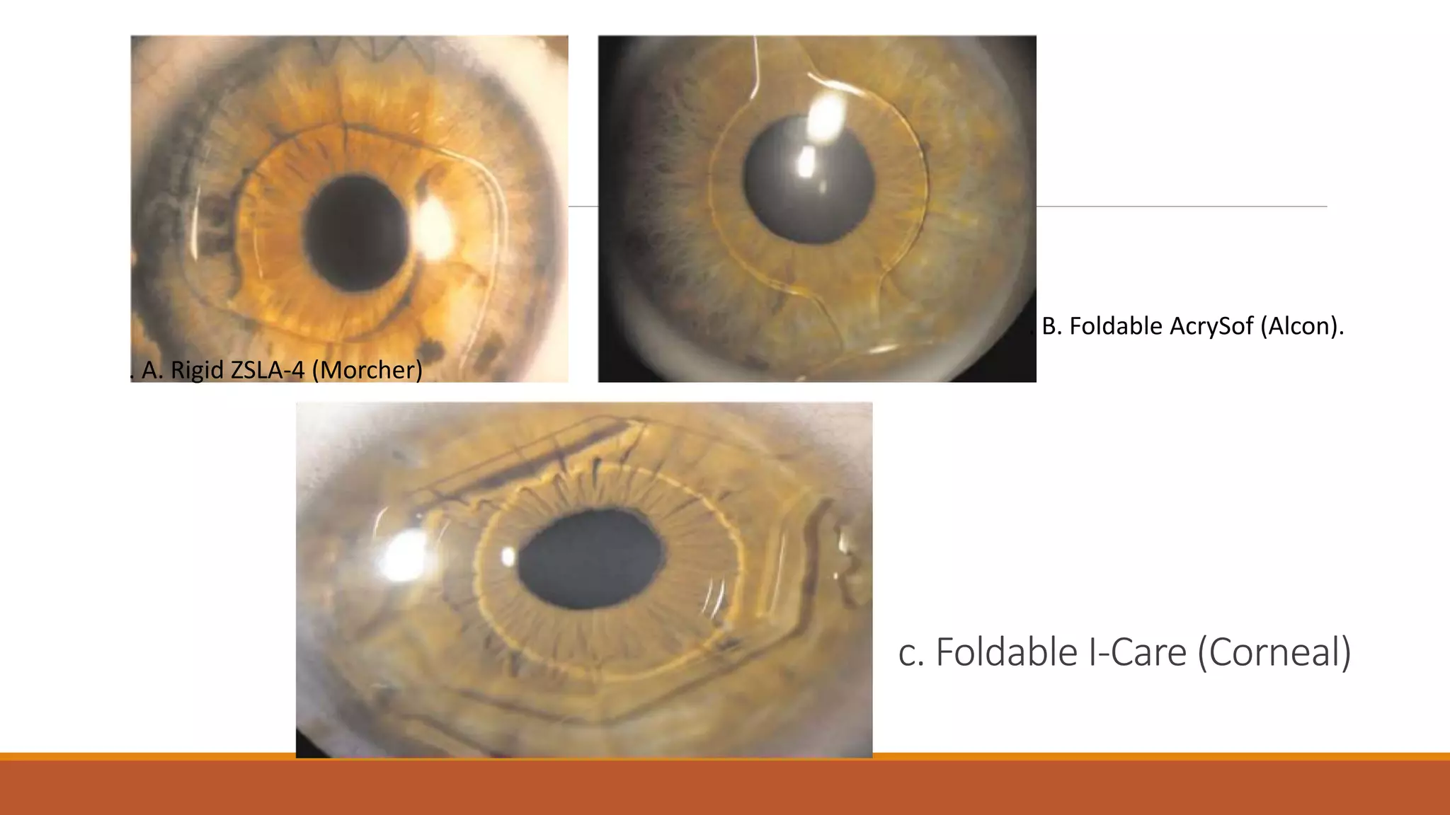 Phakic iol ppt | PPTX