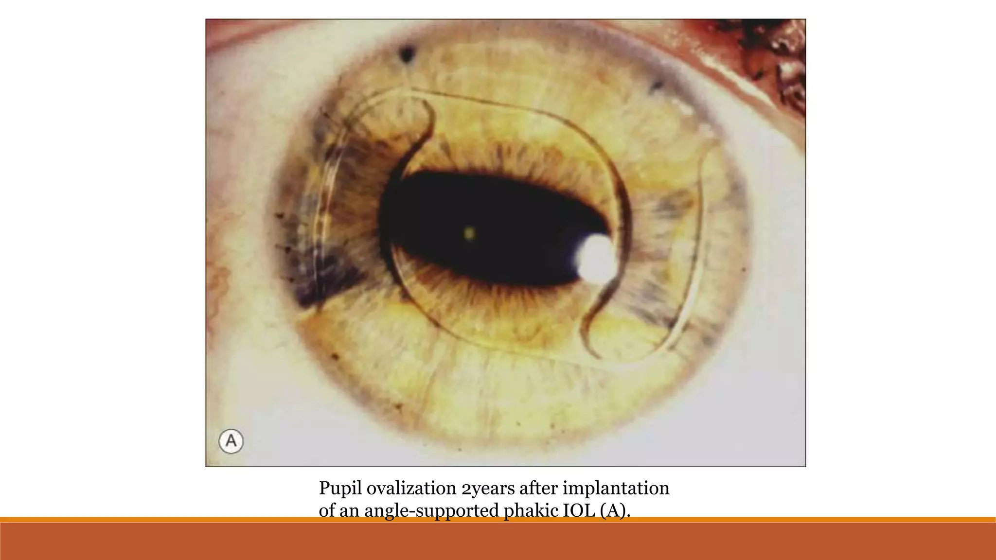 Phakic iol ppt | PPTX