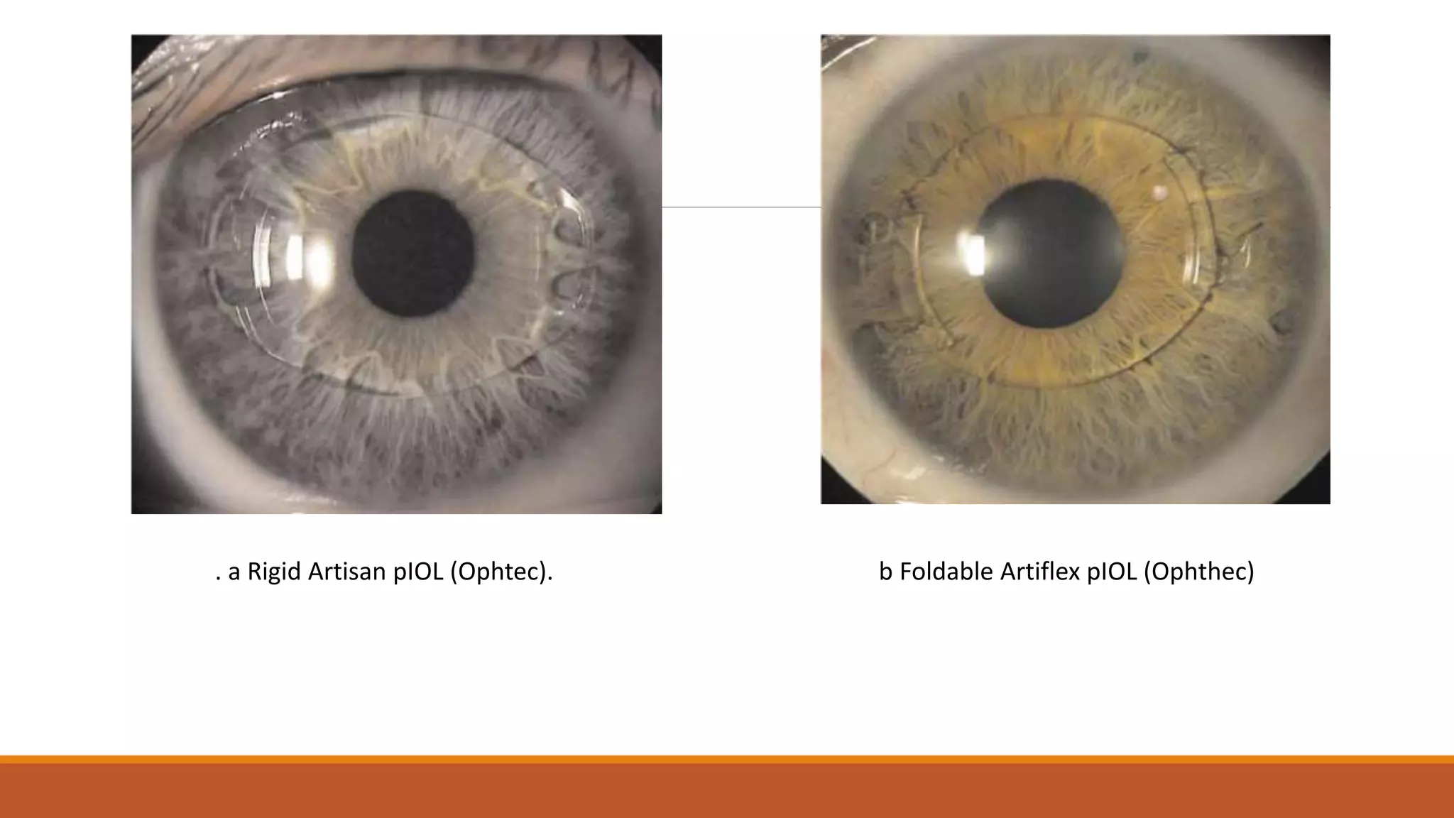 Phakic iol ppt | PPTX