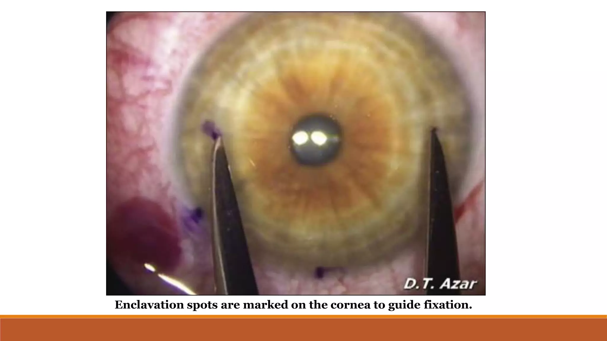 Phakic iol ppt | PPTX