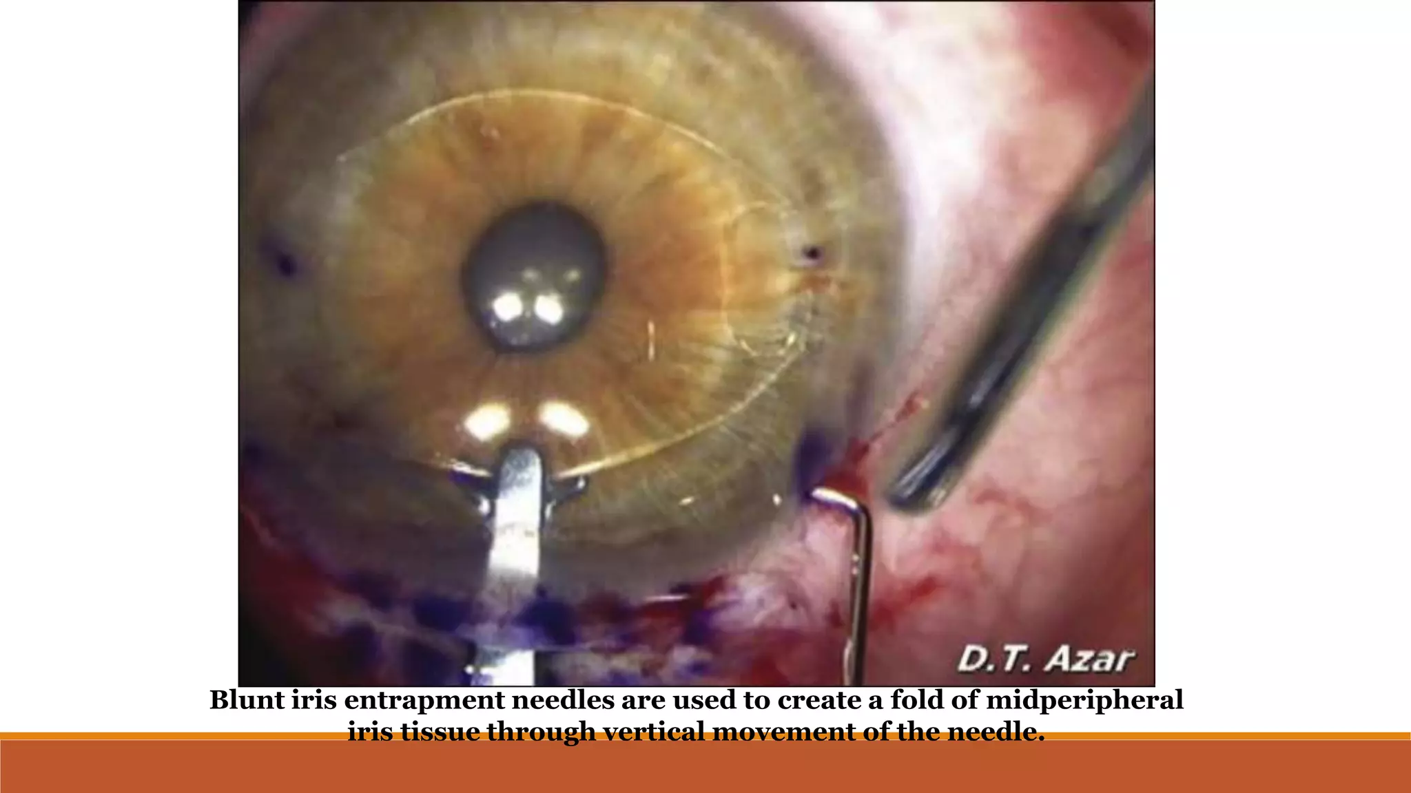 Phakic iol ppt | PPTX